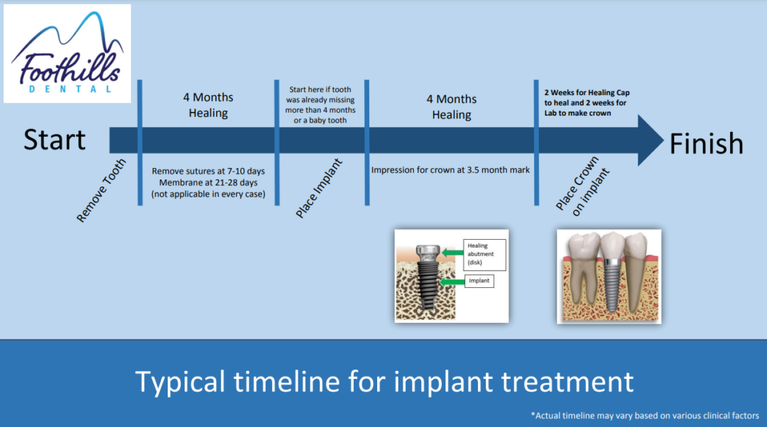 Dental Implants – Foothills Dental